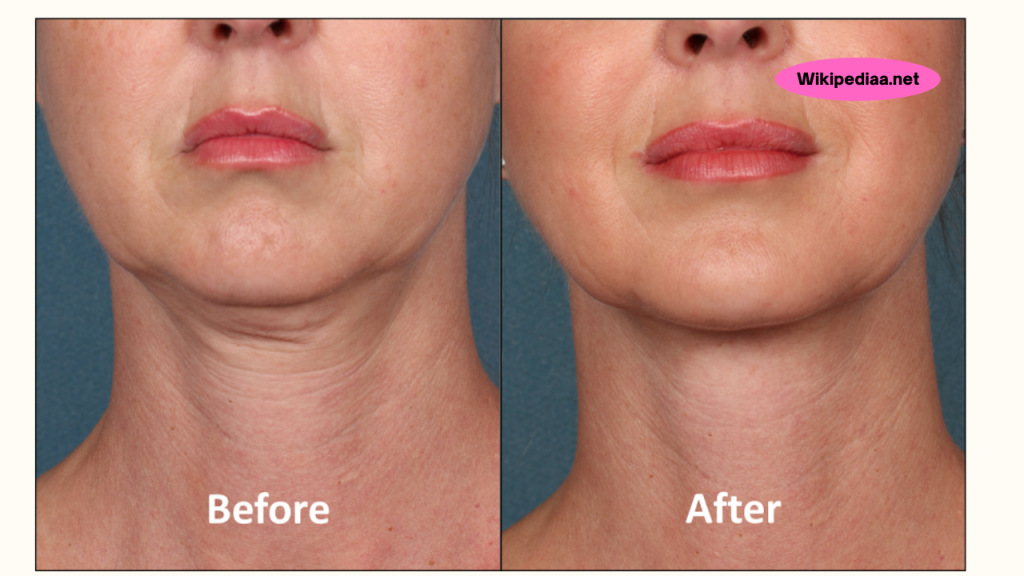 9 Helpful Ways to Get Rid Of Neck Fat